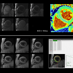 Role of T1 mapping as a complementary tool to T2* for non-invasive ...