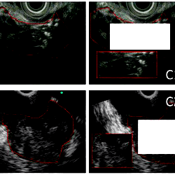 The processes of EUS image selection.