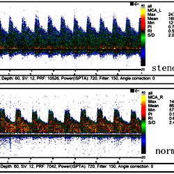 Normal and typical TCD waveform indicative of ICAS in the middle ...