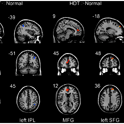 Brain areas with significant ReHo differences between simulated ...