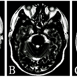 A 47-year-old man with acute otitis media with effusion of MRI ...