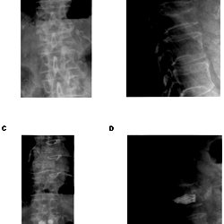 Case presentation with Osseofix® system.