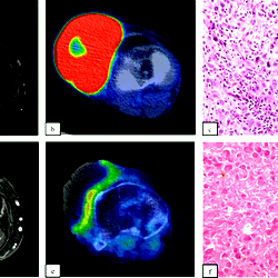 A typical patient treated with RHC therapy (patient no. 10).