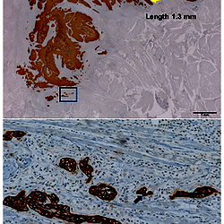 Photographs of immunohistochemical pancytokeratin staining show ...