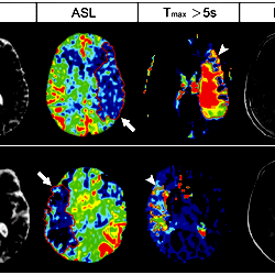 ADC, ASL perfusion (CBF), DSC perfusion (Tmax >5 s), and follow-up ...