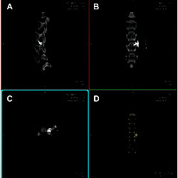 Contrast dye distribution in post-injection control Dyna-CT images.