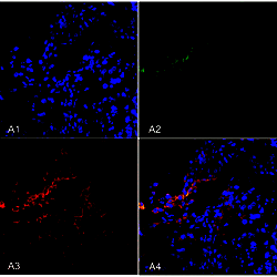 HE4 and Lewis y colocalize in ovarian malignant tumors using double ...
