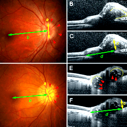 Measurements and classification of visual field defects.