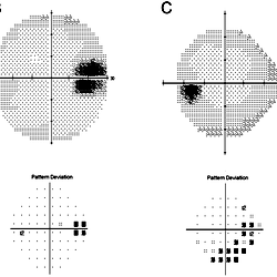 Types of visual field defects.