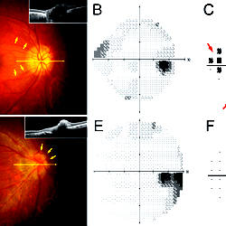 Sample cases of each type of visual field defect.