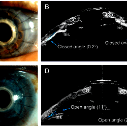Boston keratoprosthesis and open and closed angles on AS-OCT imaging.