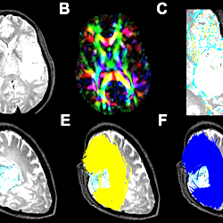 Images from P22 with a left frontal-parietal lesion.
