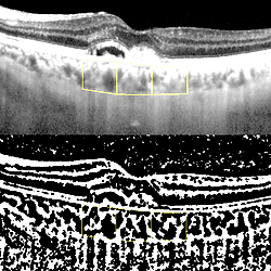 Segmentation and binarization of EDI-OCT images.