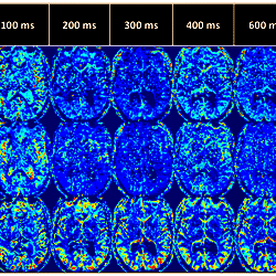 IVIM parametric maps of the blood flow related fD*, the pseudo-diffusion coefficient D*, and the ...