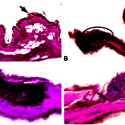 Geomyces destructans colonization of superficial epidermis occasionally ...