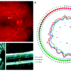 Oncotic lesions (CWS) in the retinal nerve fiber layer were investigated.