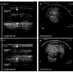 Ultrasonography of the superficial digital flexor tendon.