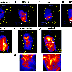 Lymphatic imaging using ICG.