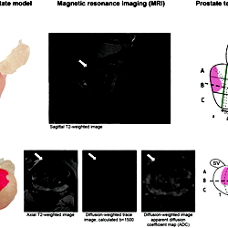Prostate cancer lesion of case 3 according to 3D printed prostate model ...