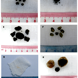 The appearance of each type of gallbladder stone.