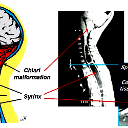 Simplistic representation and corresponding MR images (T1) of the CSF ...