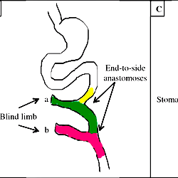 Schematic of Roux-en-y model.