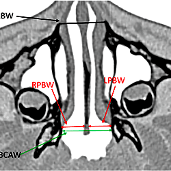 Measurements of nasal cavity dimensions in children with ...