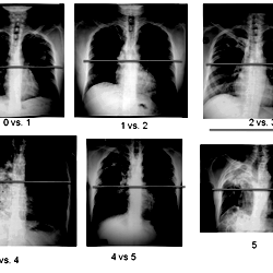 Representative example radiographs of quadrants for each score ...