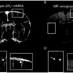 Comparison of 3D gas ΔR2*-mMRA and MR venography.