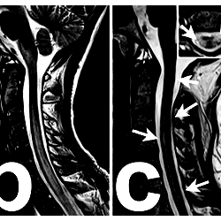 Differential diagnosis of NMO/NMO-SD associated LETM.