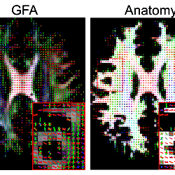 The filtering results using FA, GFA, anatomical information, and QA.