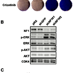 NF1 suppression leads to ERK activation and confers resistance to ALK ...