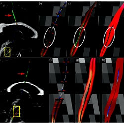 Hyperstreamlines and streamribbons for a tract from the cortico-spinal ...