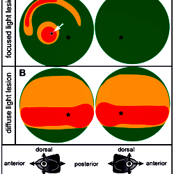 Schematic illustration of lesion patterns.