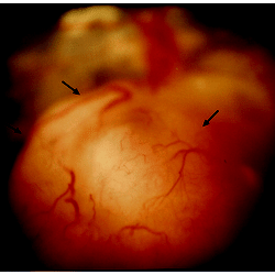 Photograph of the fundus showing a pink-white tumor of the right retina ...