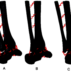 Three 3D FE models were established.