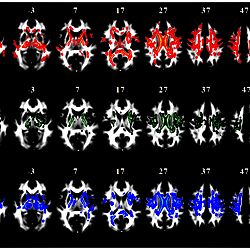 TBSS results: areas of decreased fractional anisotropy (FA, red-yellow ...
