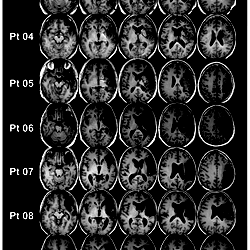 Lesion patterns of individual patients.