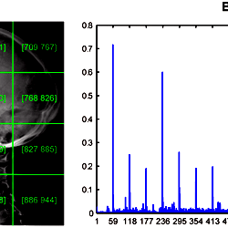A medical image and its LBP histogram.