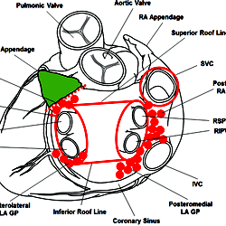 Hybrid procedure with ablation lesions.