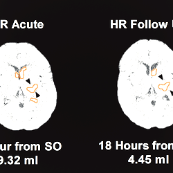 Example of HR in a patient with a left thalamic ICH and associated IVH.