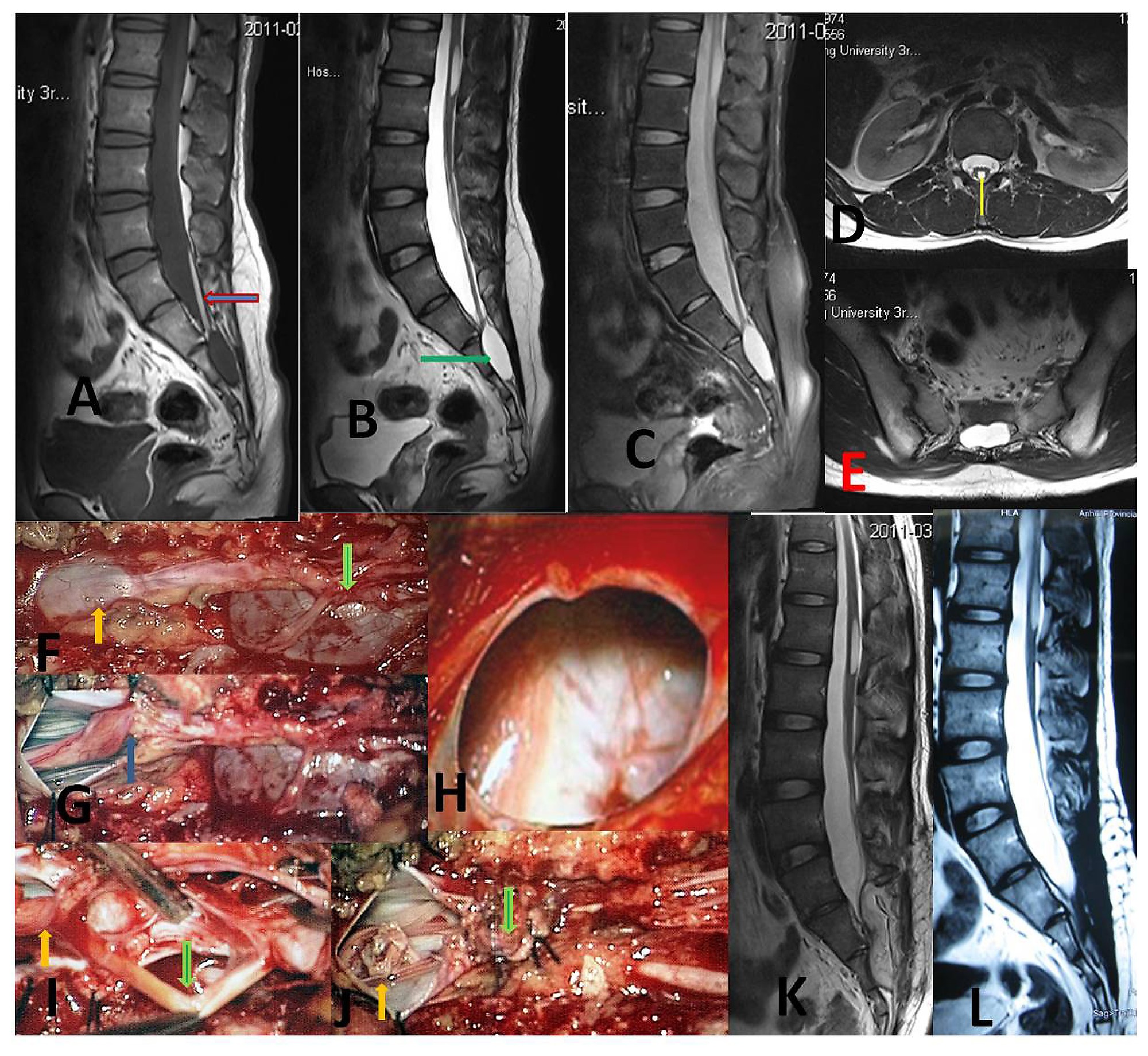 Sacral Canal Cyst