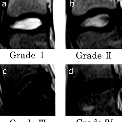 Standard T2-weighted MRI sagittal images of each Pfirrmann grade.