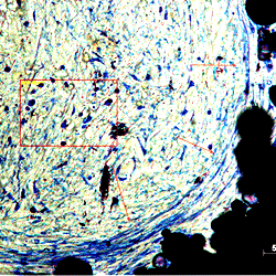 Soft-tissue infiltration in Zone 1 of Group 3.