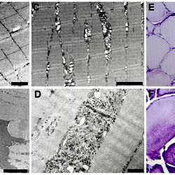 Ultra-thin section of muscle cell from individual with hard texture ...