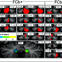 Lesion reconstruction in FCb+ and FCb− patients.
