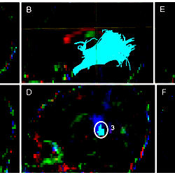 Location of ROIs on DTI color maps for the optic radiation (OR) in a ...