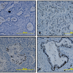 CDX2 expression in PDAC.