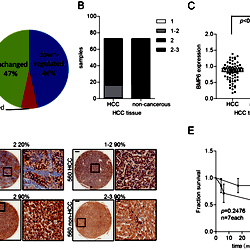 The BMP-6 IHC staining intensity is downregulated in HCC tissue.
