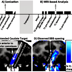BBB opening procedure overview.
